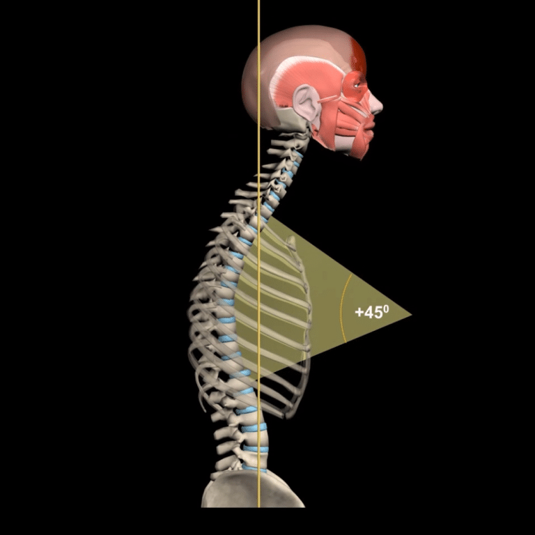 Kyphosis | Symptoms, Causes, and Treatments | BLOG