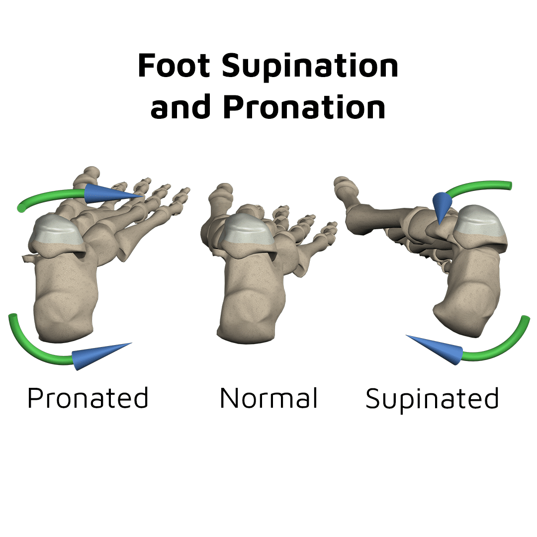 The Chain Effects of Foot Overpronation | Muscle and Motion Blog