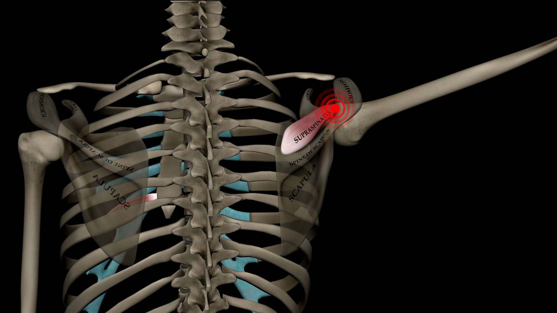 The Evolution of Shoulder Impingement